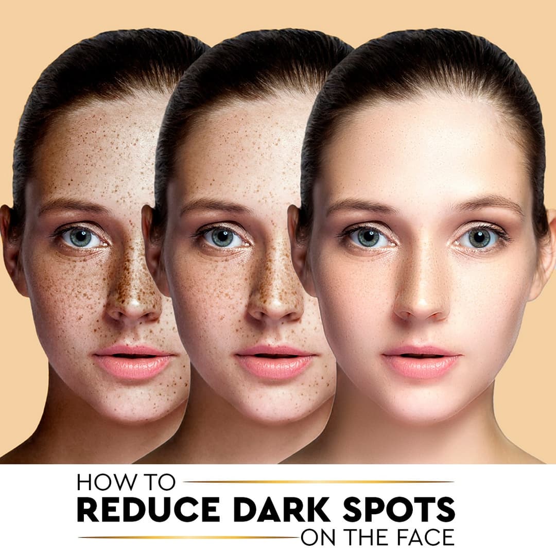 Dark spots on face: Causes & Solutions