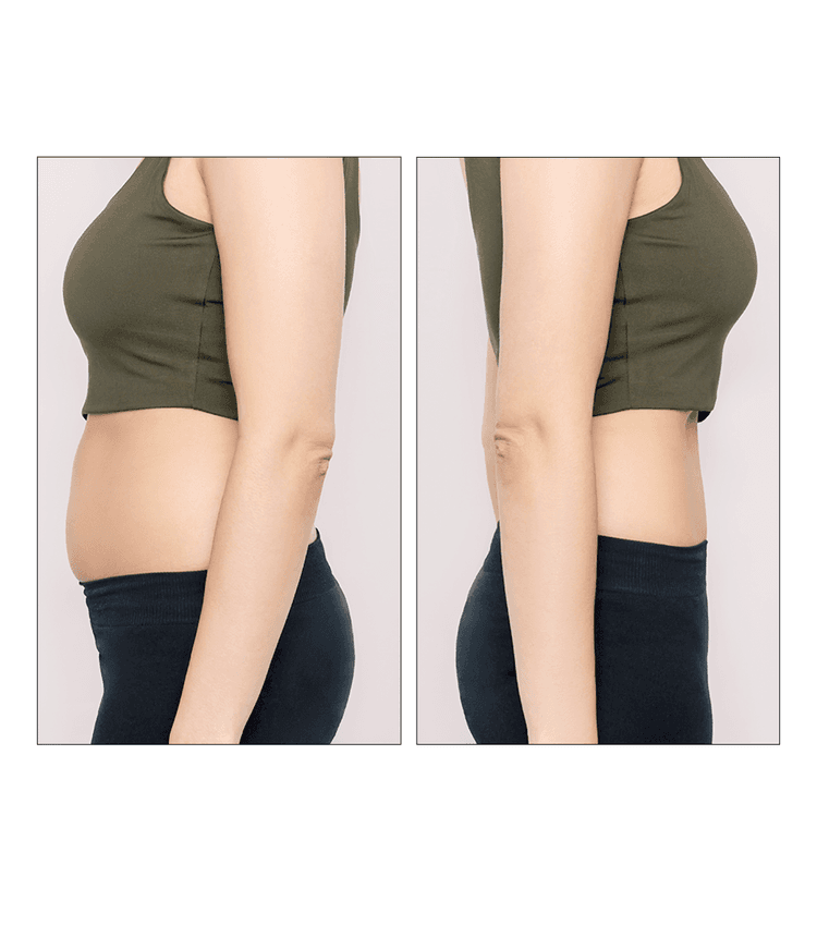 Lipo Laser Slimming Treatment Cost for Non Surgical Fat Loss | VLCC