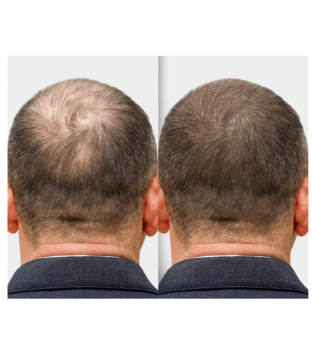 GFC Hair Treatment Cost for hair regrowth | Hair Fall Treatment| VLCC