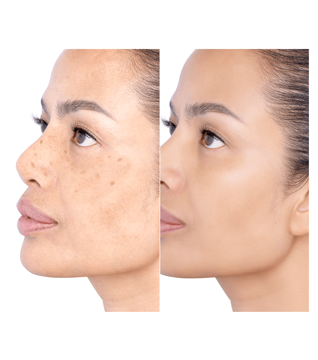 Inno Peel & Mango Peel Skin Whitening Face Exfoliation | VLCC